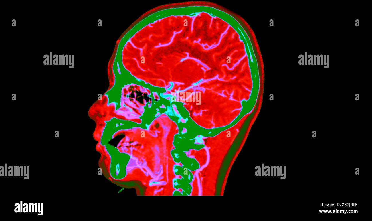Ct Angiography Of The Brain Or Cta Brain And Neck Sagittal View 3d Rendering Image Fusion Color
