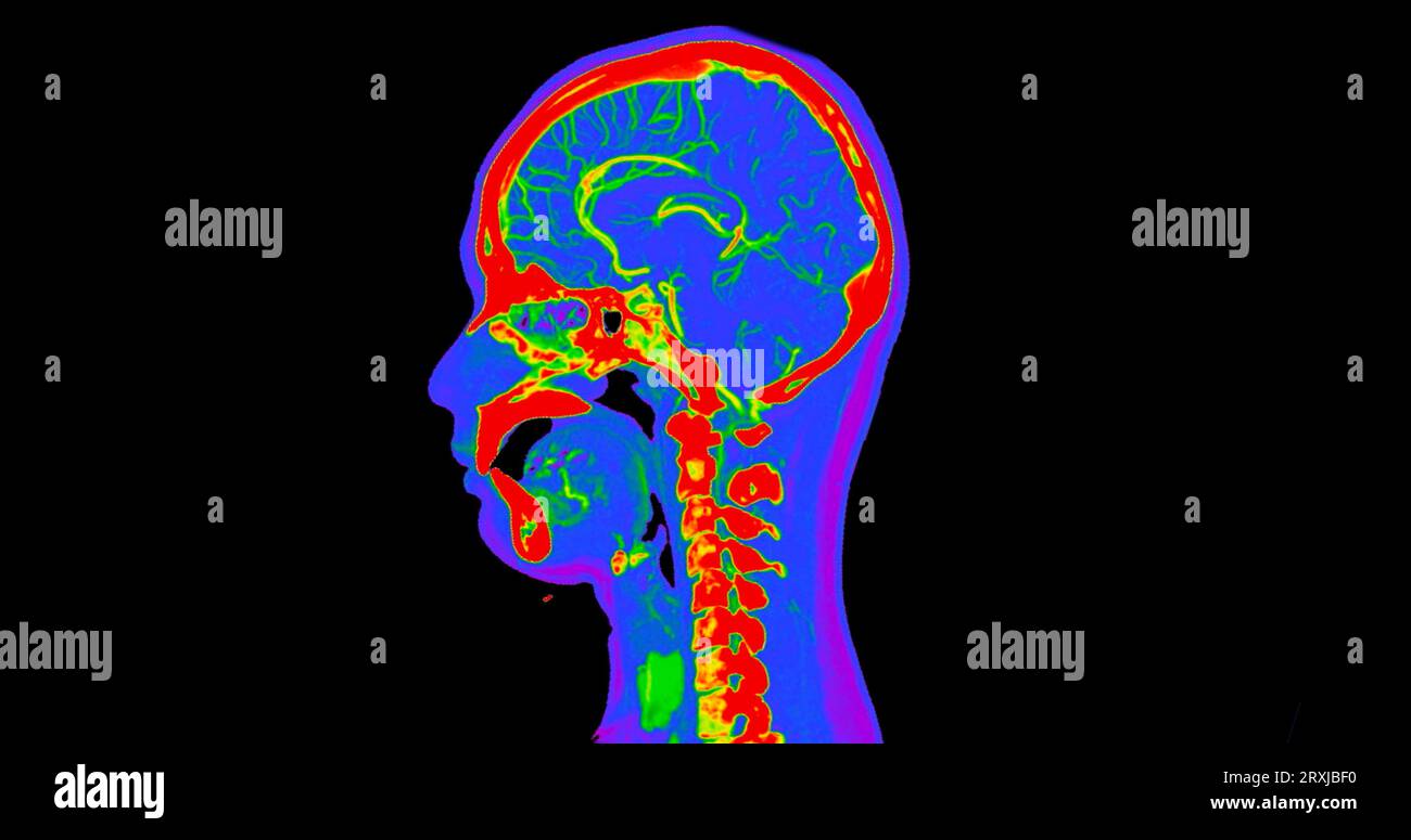CT angiography of the brain or CTA brain and neck Sagittal view 3D ...