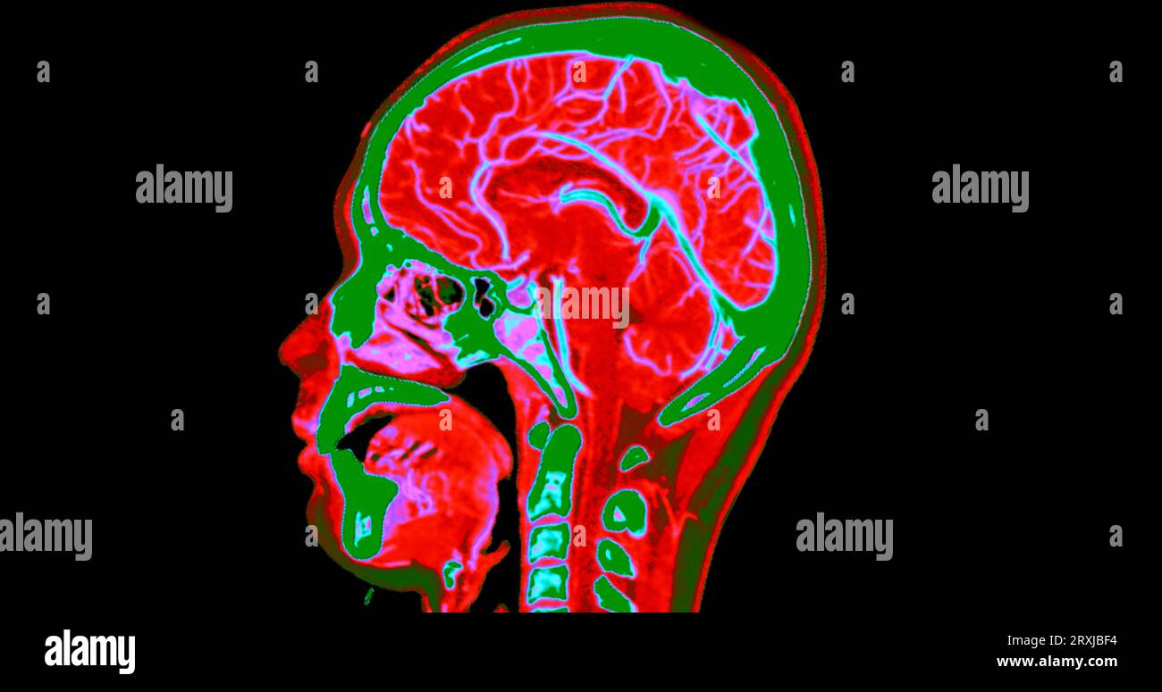 CT angiography of the brain or CTA brain and neck Sagittal view 3D ...