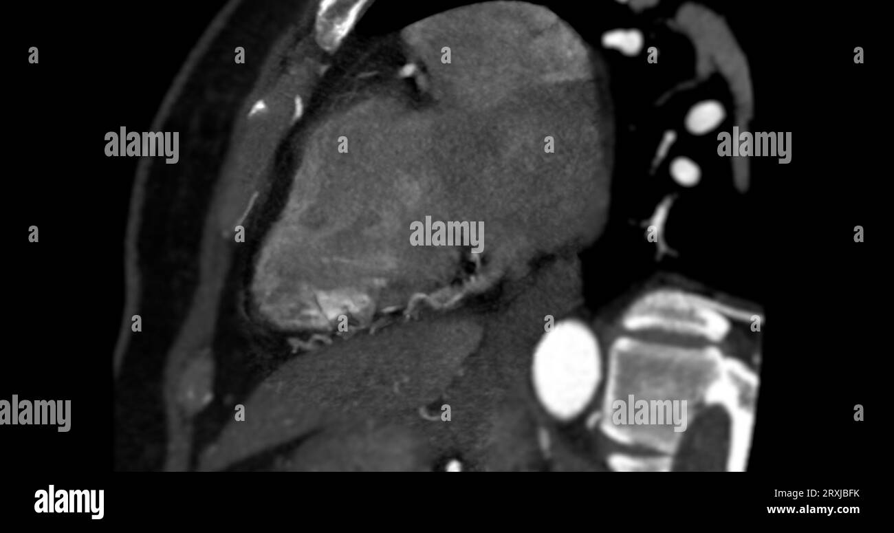 CTA Coronary artery vertival long axis view for diagnosis of vessel ...