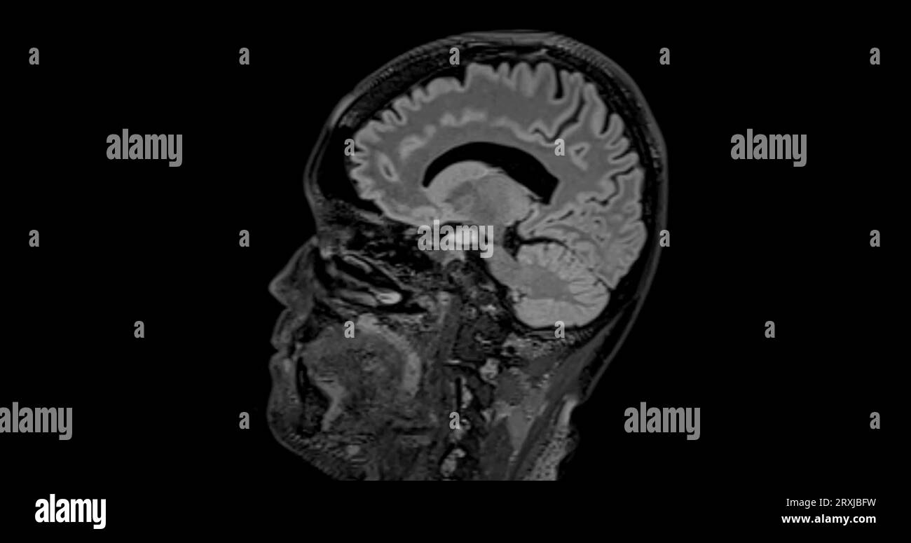 MRI brain scan sagittal flair for detect Brain diseases sush as stroke disease, Brain tumors and ...