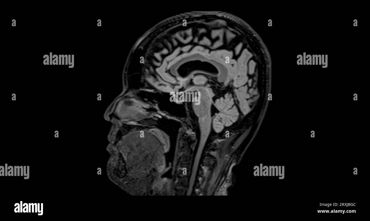 MRI brain scan sagittal flair for detect Brain diseases sush as stroke ...