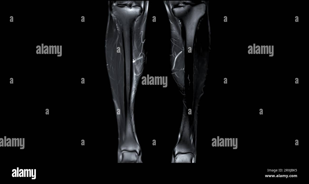MRI Scan of both leg coronal view Stock Photo - Alamy