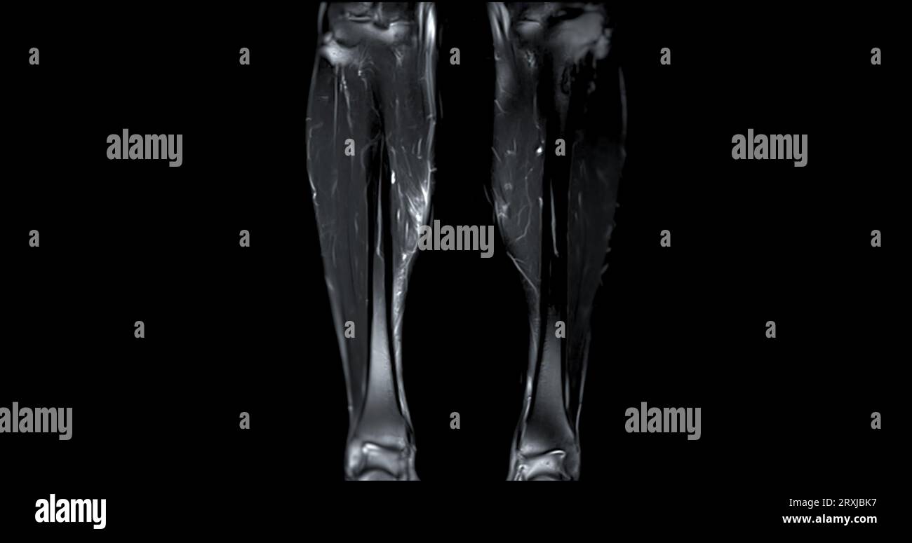 Knee mri coronal view hi-res stock photography and images - Alamy