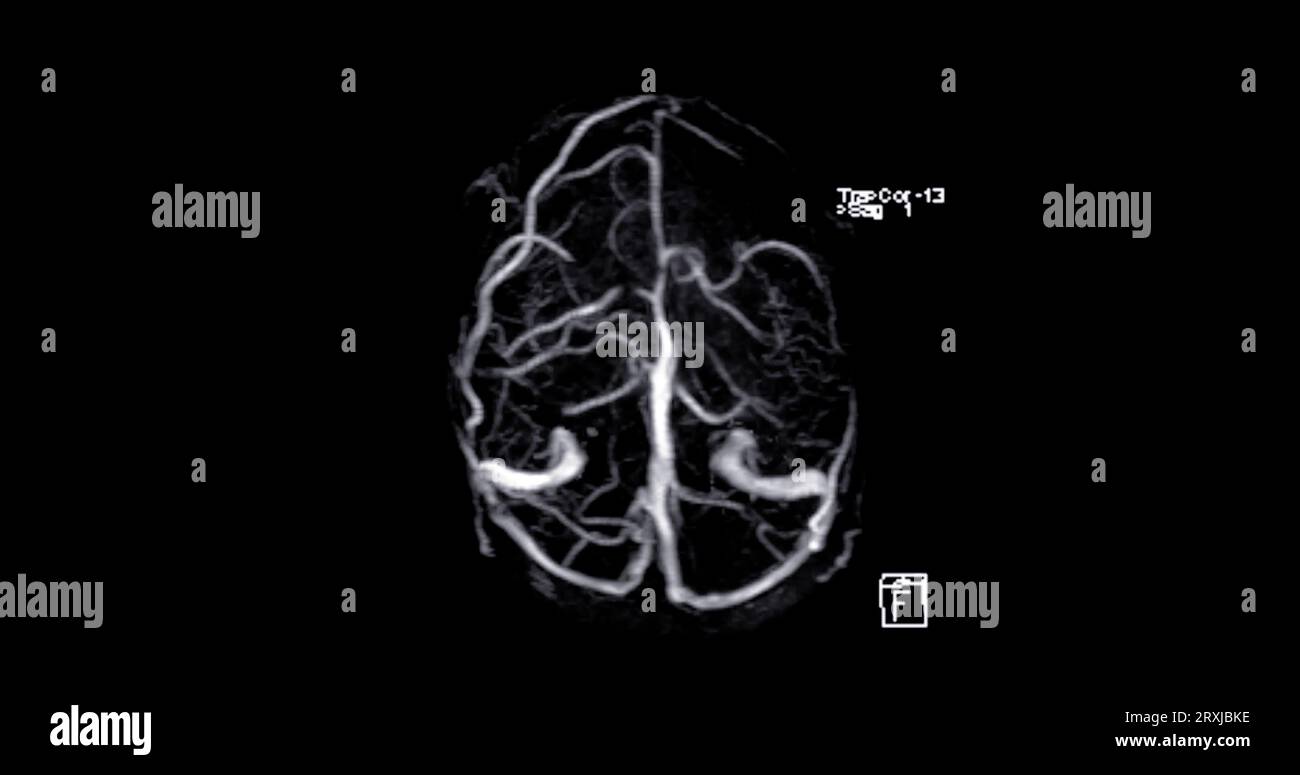 MRV Brain or magnetic resonance venography of The Brain for diagnosis ...