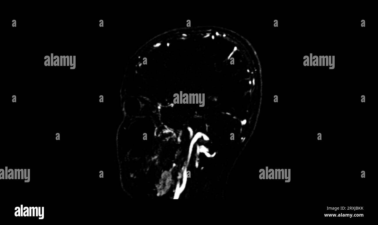 MRV Brain or magnetic resonance venography of The Brain for diagnosis ...