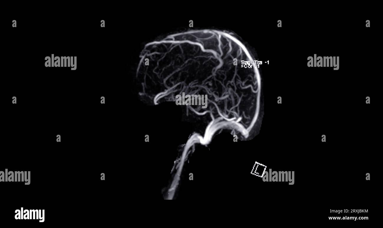 MRV Brain or magnetic resonance venography of The Brain for diagnosis ...