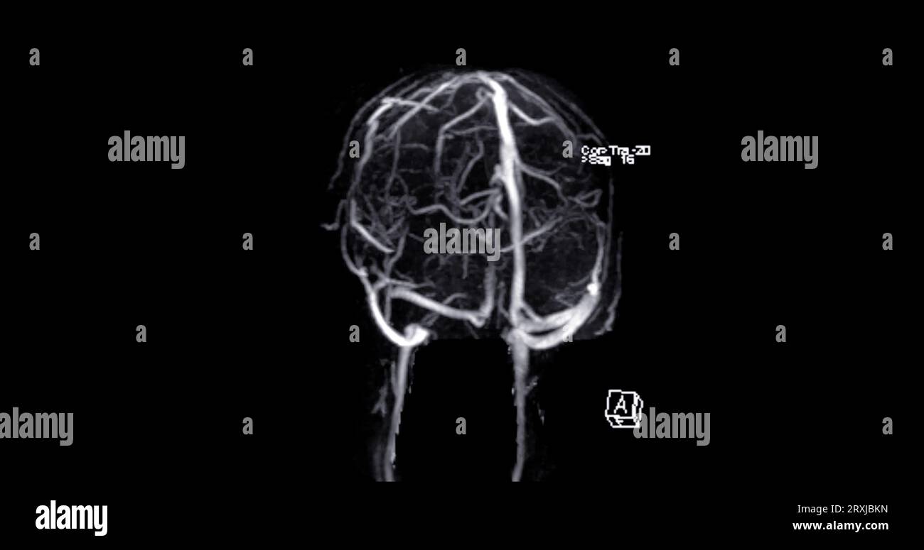 MRV Brain or magnetic resonance venography of The Brain for diagnosis ...