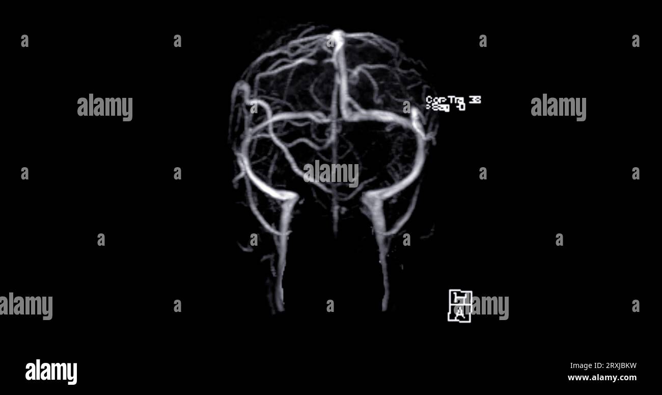 MRV Brain or magnetic resonance venography of The Brain for diagnosis ...