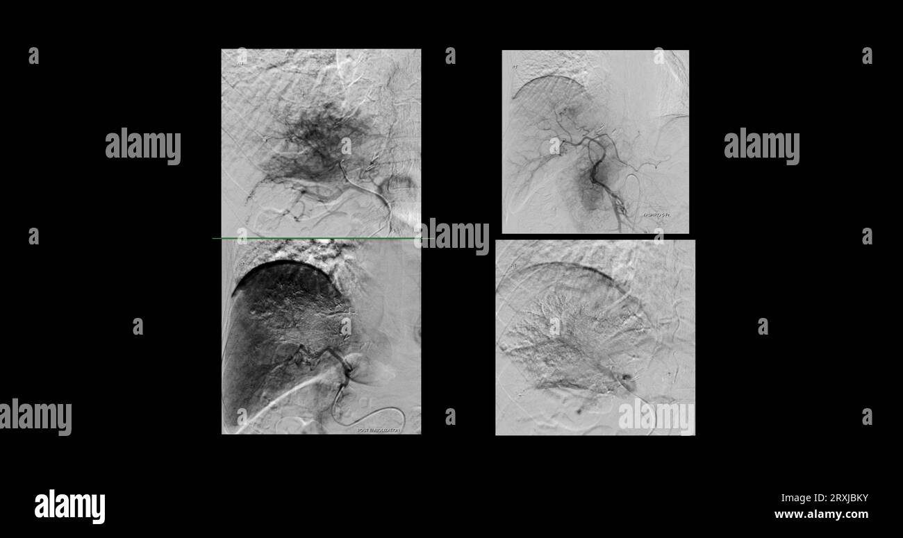 Abdominal catheter hi-res stock photography and images - Alamy