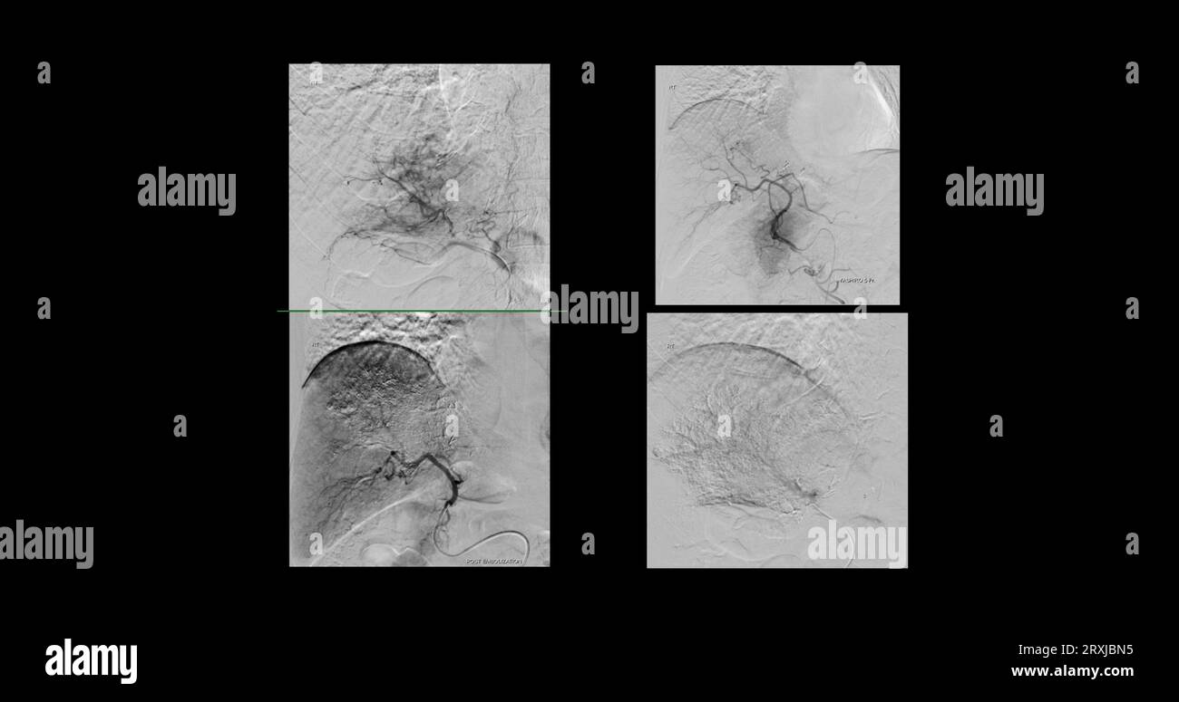 X-ray image of TACE or Chemoembolization is a procedure that allows a ...
