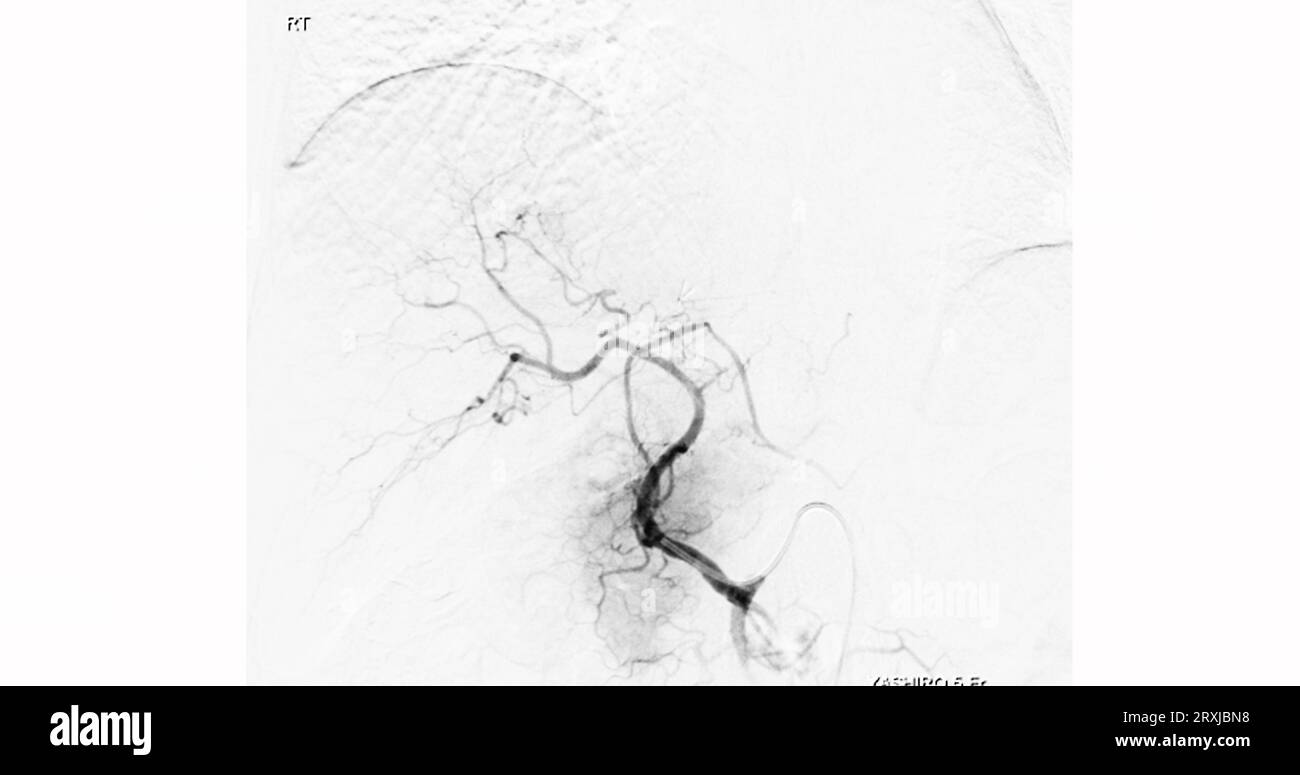 X-ray image of TACE or Chemoembolization is a procedure that allows a ...