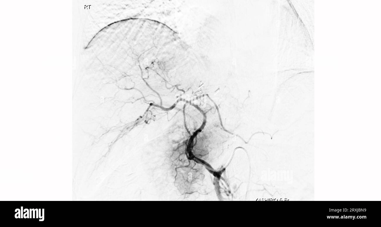 X-ray image of TACE or Chemoembolization is a procedure that allows a ...
