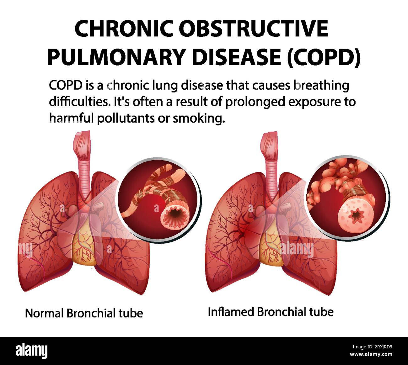 Illustrated infographic explaining chronic obstructive pulmonary ...