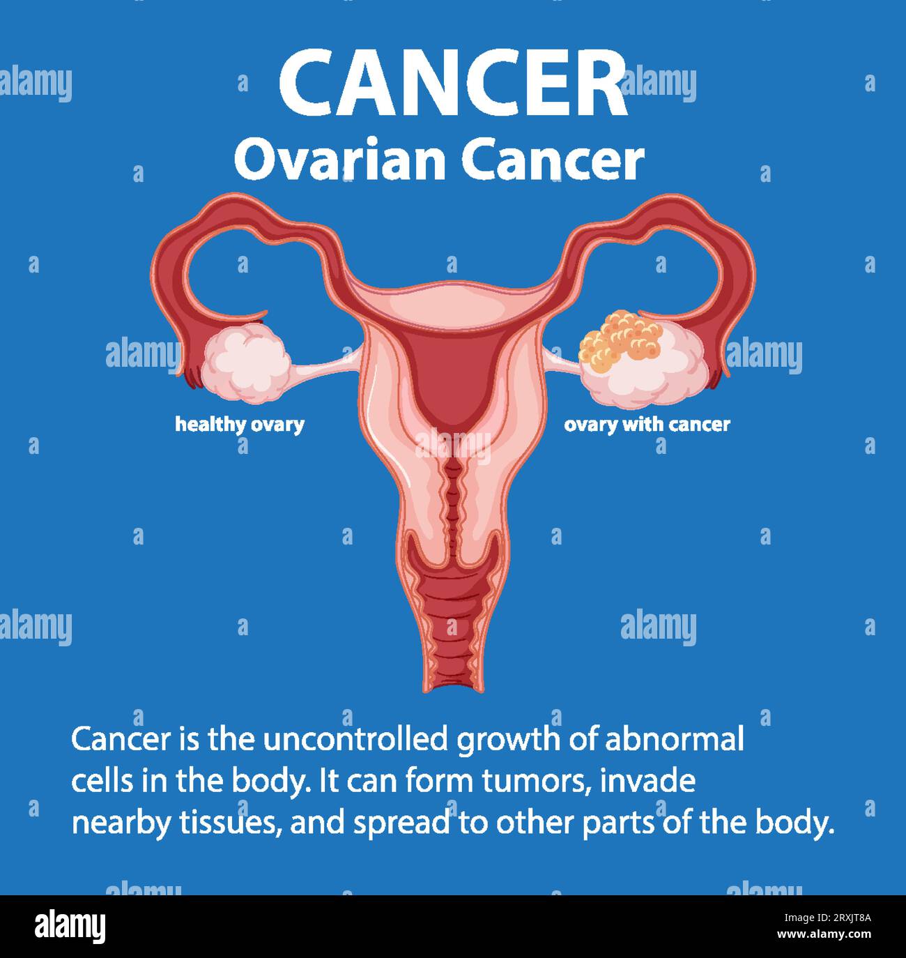 Illustration highlighting differences between healthy and cancerous ovaries Stock Vector Image ...