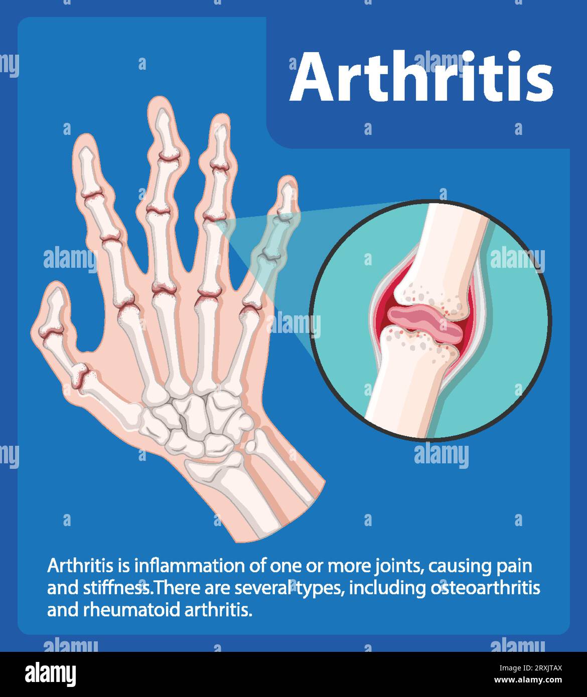 Learn about arthritis stages through a science education infographic ...