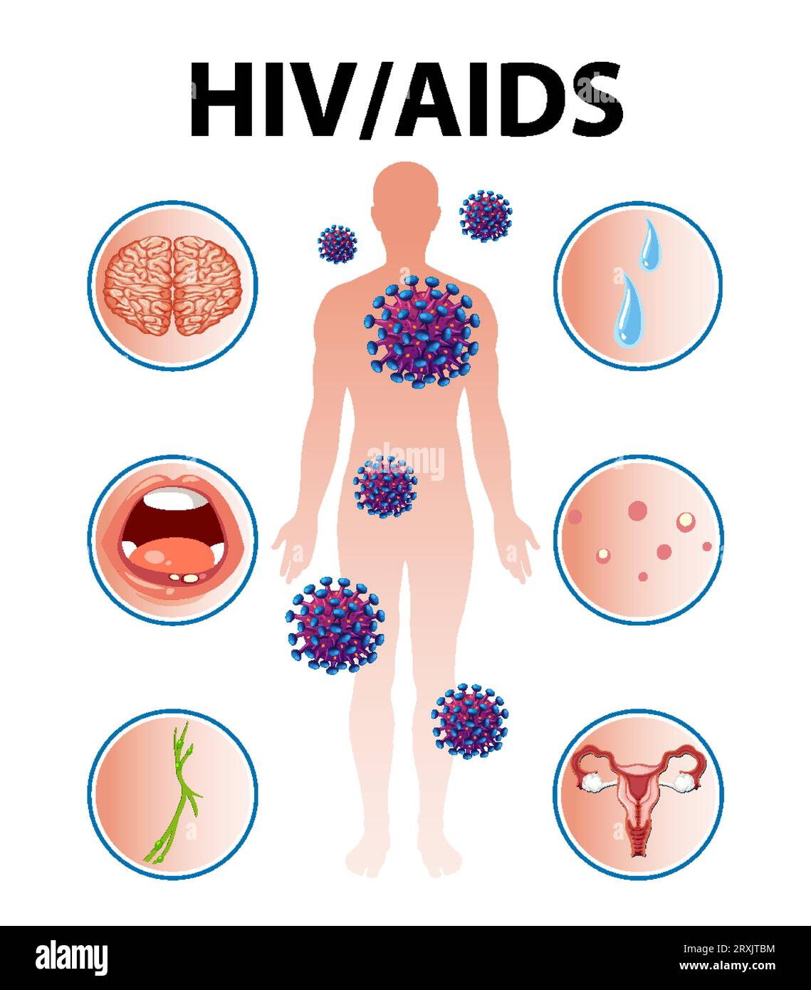 Illustration Depicting The Impact Of Hiv Aids On The Human Body Stock