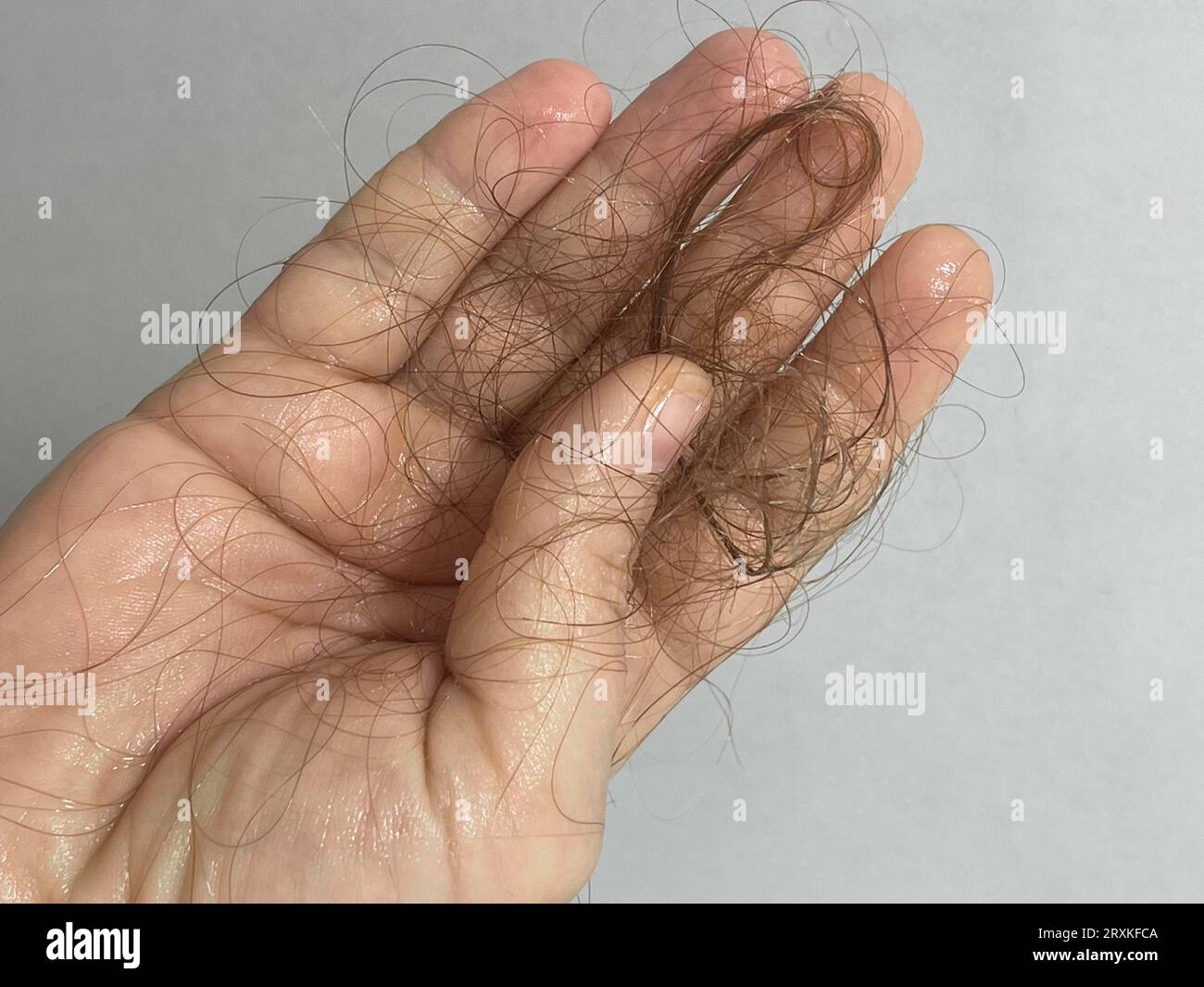 Hand with loss hair, hairloss problem. Hair treatment and therapy ...