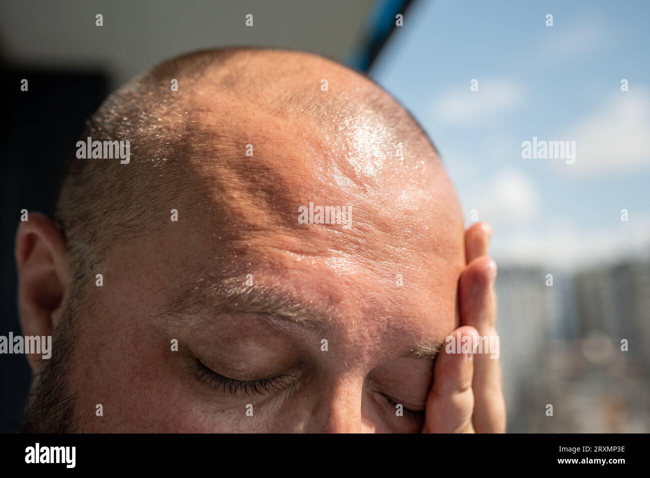 Man forehead sunstroke sweat on face, bald head. Guy suffers from heat ...