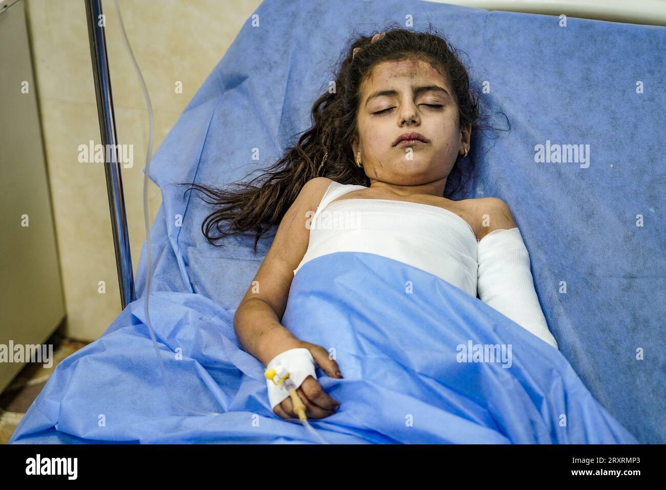 Hamdaniya, Iraq. 27th Sep, 2023. An Iraqi girl with burns in multiple ...