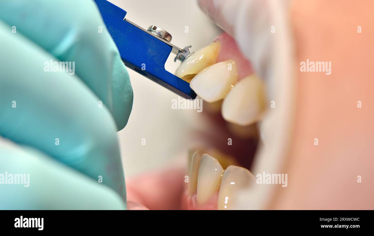 Fixing teeth hi-res stock photography and images - Alamy