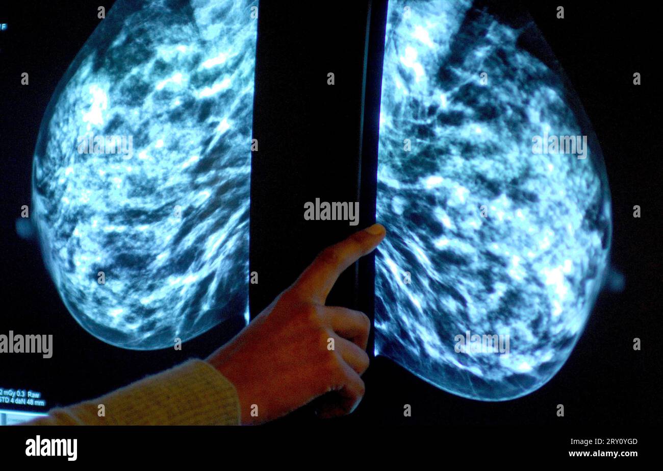 File photo dated 15/06/06 of a mammogram showing a woman's breast in ...