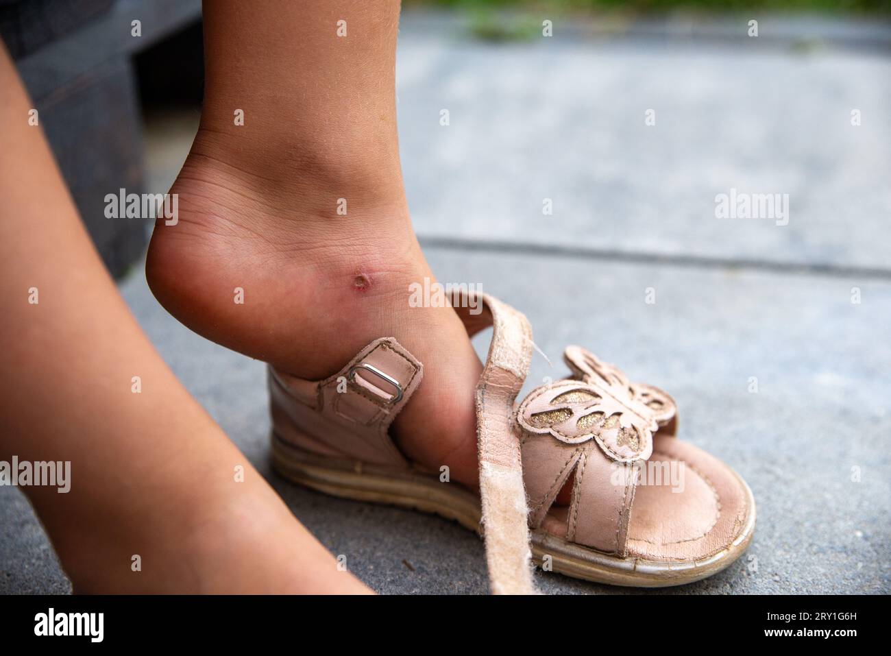 callus on the foot, torn skin, girl's health problems Stock Photo - Alamy