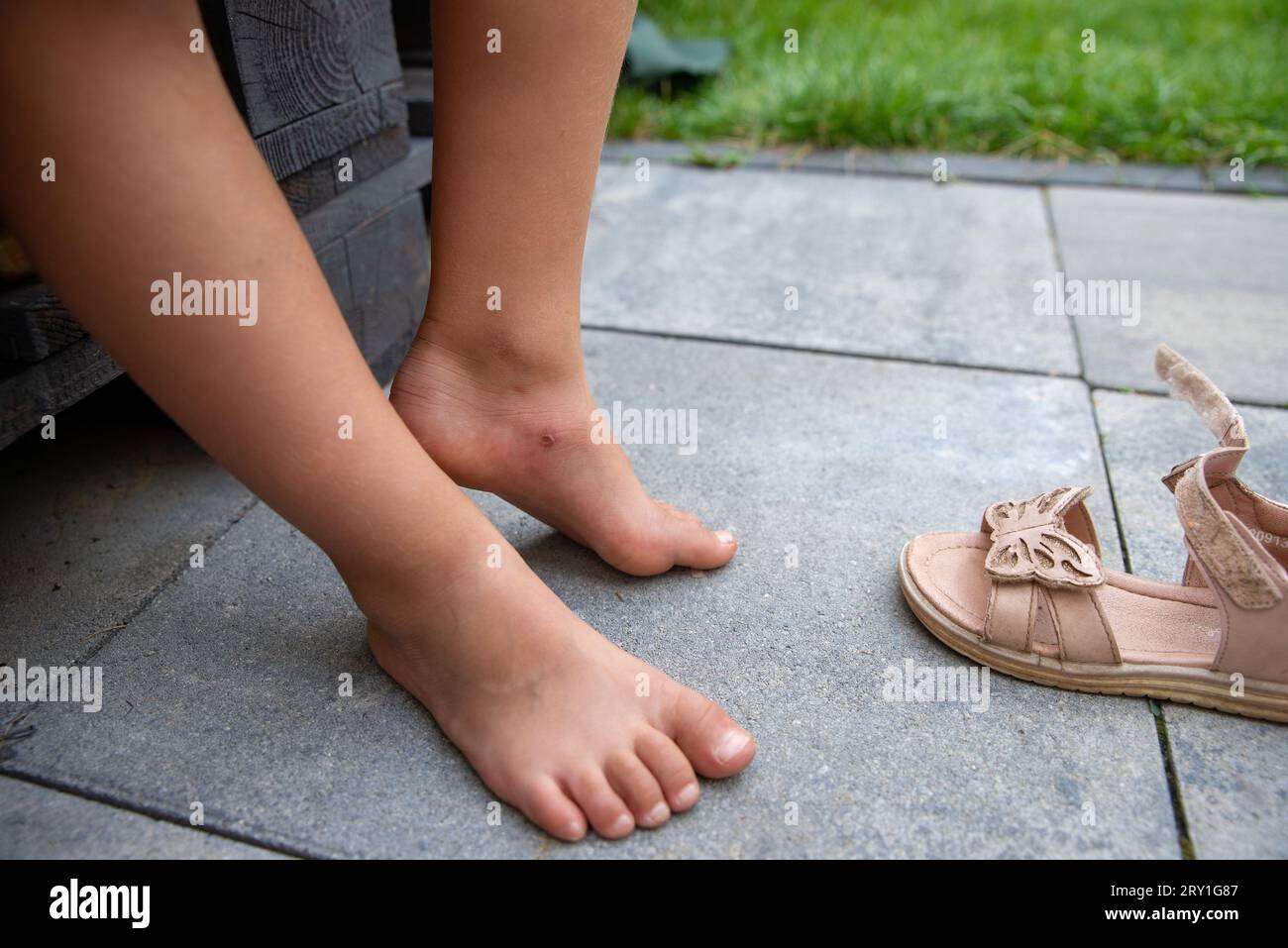callus on the foot, torn skin, girl's health problems Stock Photo - Alamy