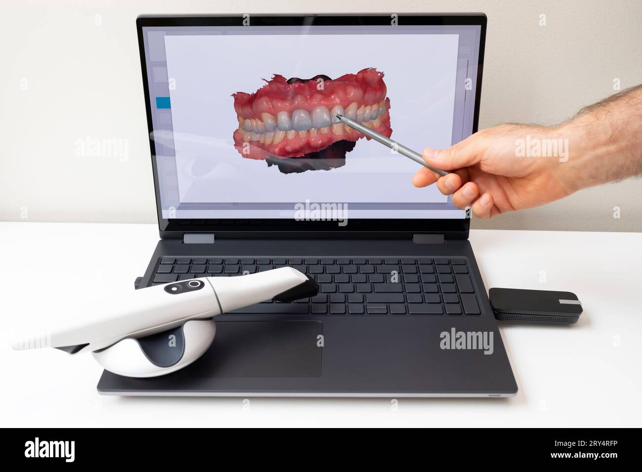 Dentist Shows 3D Scanned Picture of Scanned Teeth on Monitor of ...