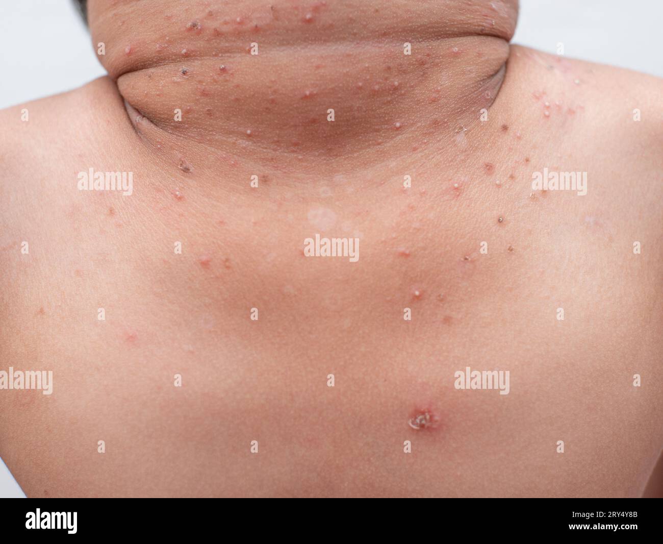 Smallpox patient hi-res stock photography and images - Alamy