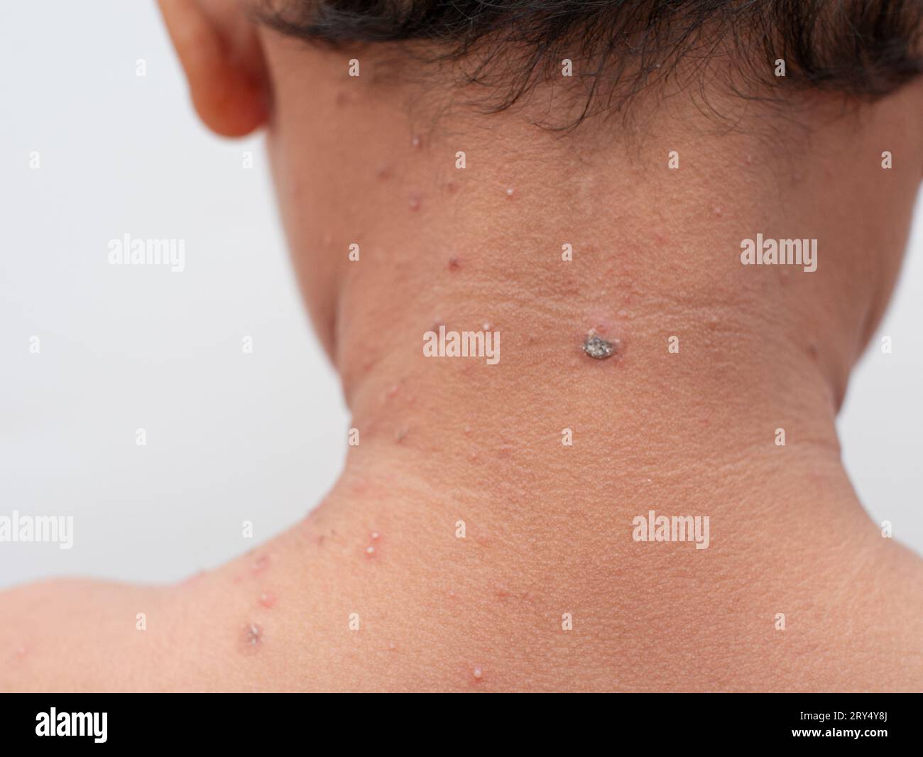 close up of child with smallpox on back of neck Stock Photo - Alamy