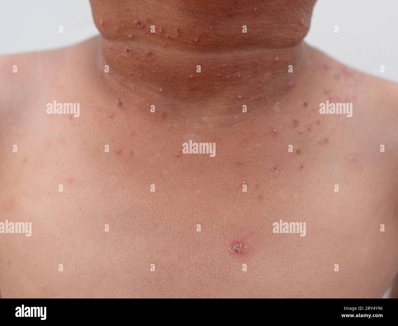 close up of child with smallpox under neck Stock Photo - Alamy
