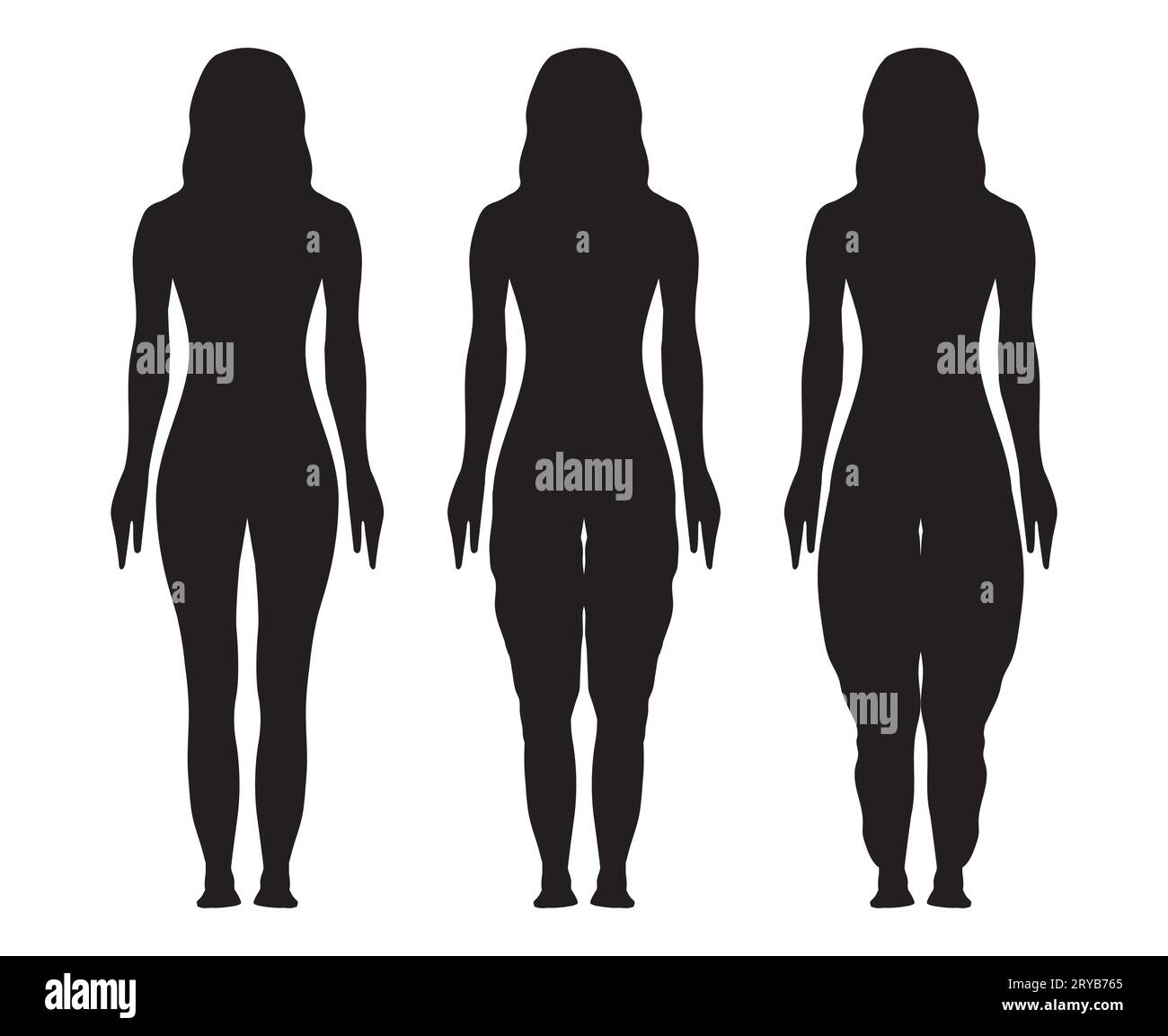 Lipedema Silhouette Illustration with Woman with Normal and Lipedema ...