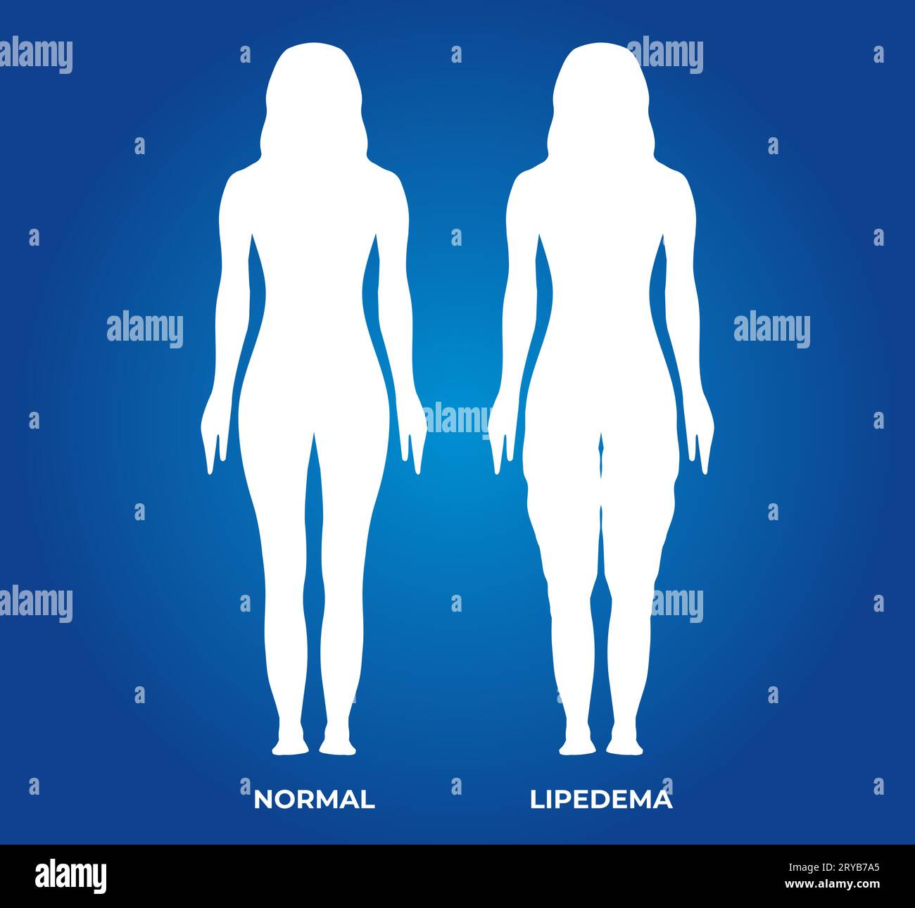 Woman Illustration Silhouette with Normal and Lipedema Legs Stock ...
