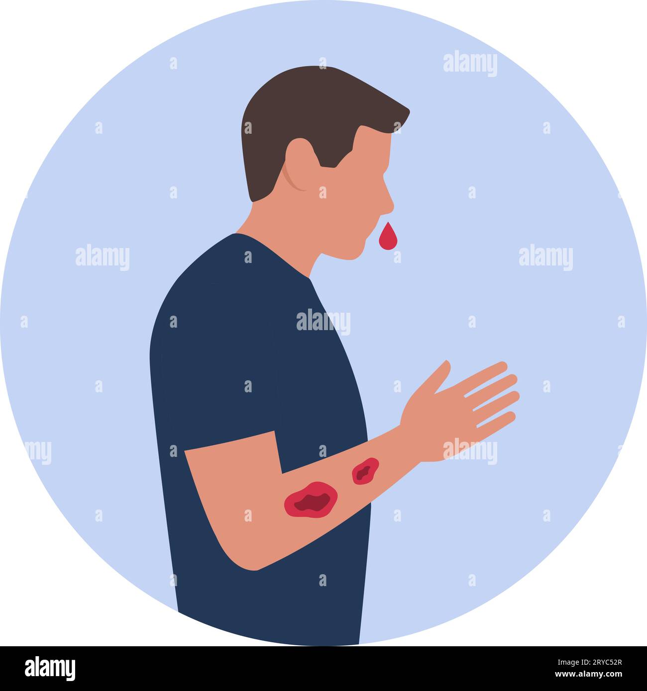 Easy bleeding, bruising and injury icon: man with nosebleed and bruises ...