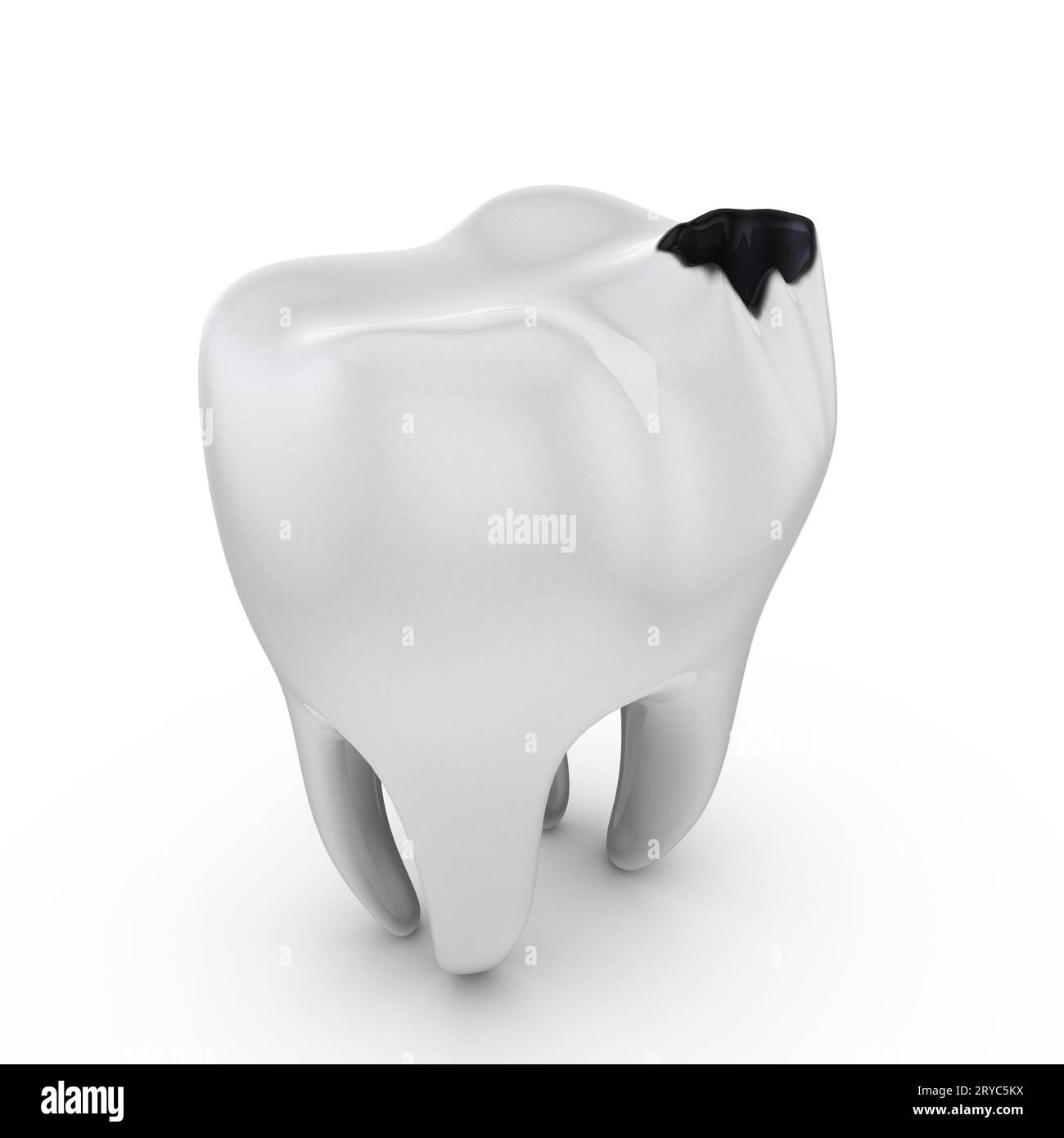 Tooth decay hi-res stock photography and images - Alamy