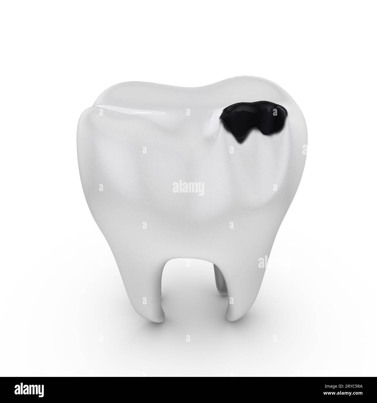 Tooth decay hi-res stock photography and images - Alamy