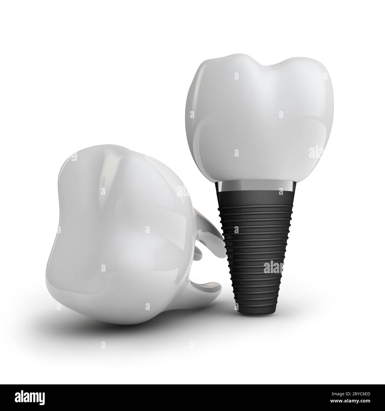 Render implants hi-res stock photography and images - Alamy