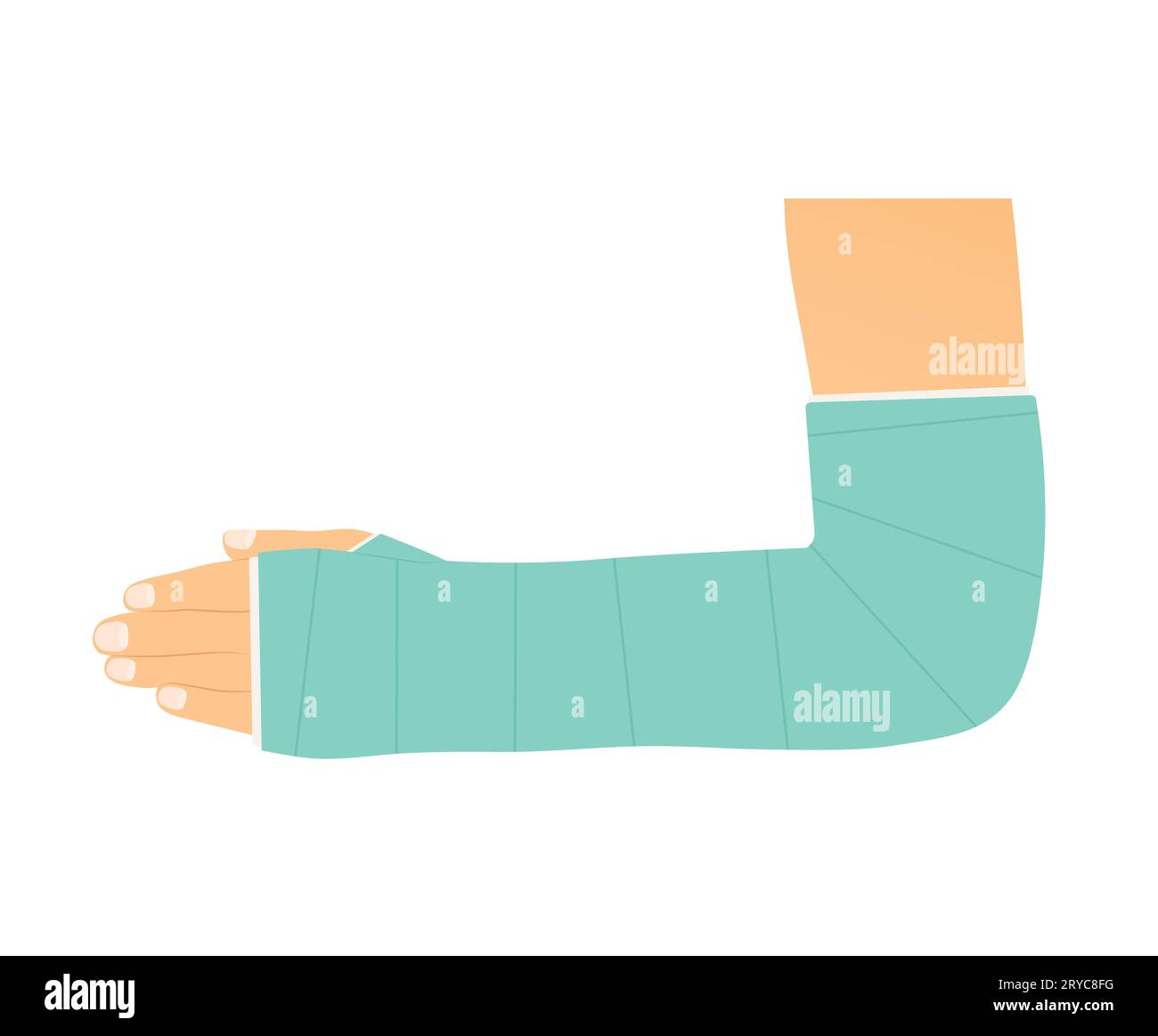 Arm broken cast elbow Stock Vector Images - Alamy