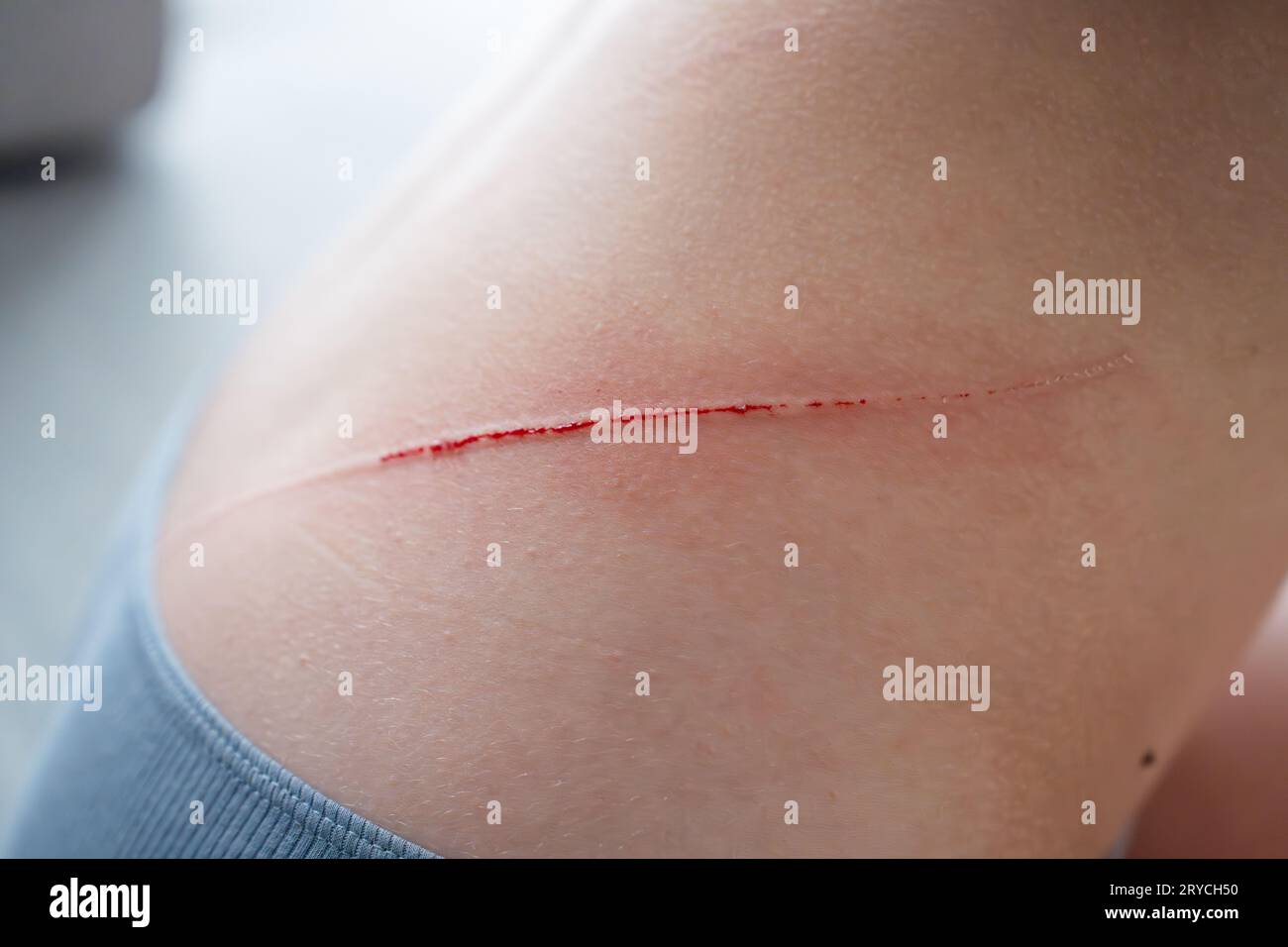 spray antiseptic on the wound on the child's back. disinfection of ...
