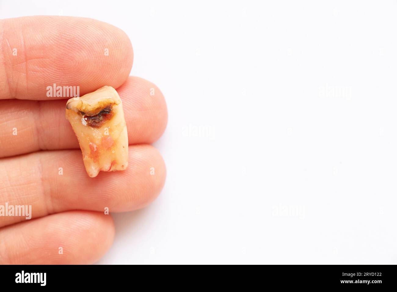 A girl in her hand holds an extracted tooth with a black hole in the ...