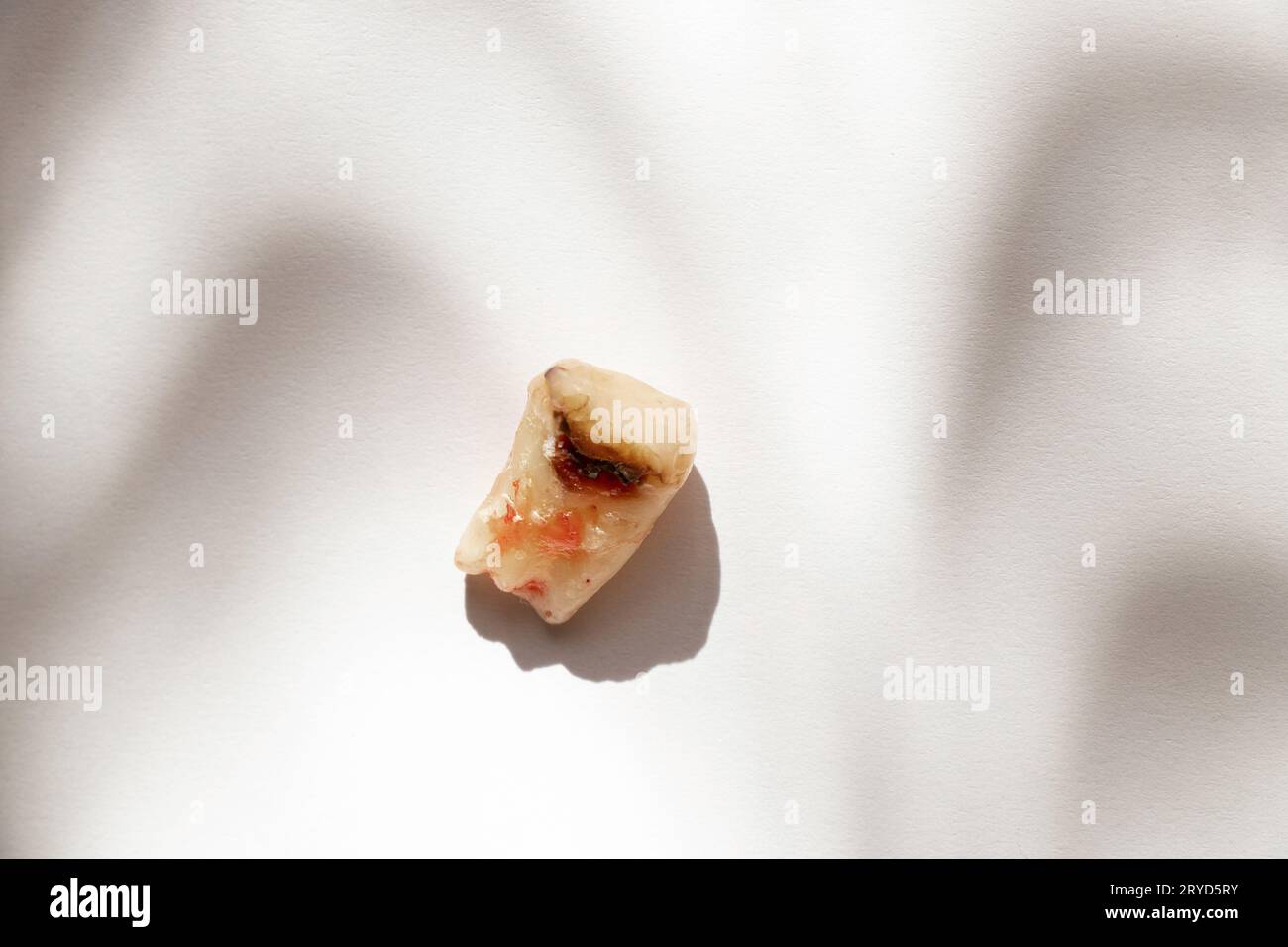 An extracted tooth destroyed with caries and a hole in the middle lies ...