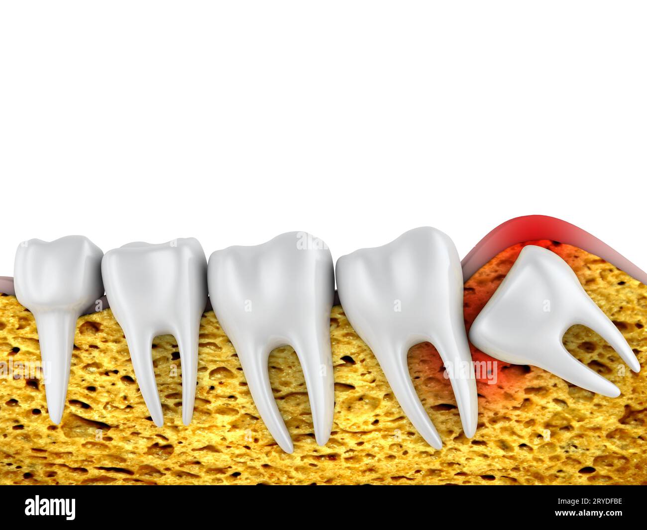 Molars and wisdom tooth Stock Photo - Alamy