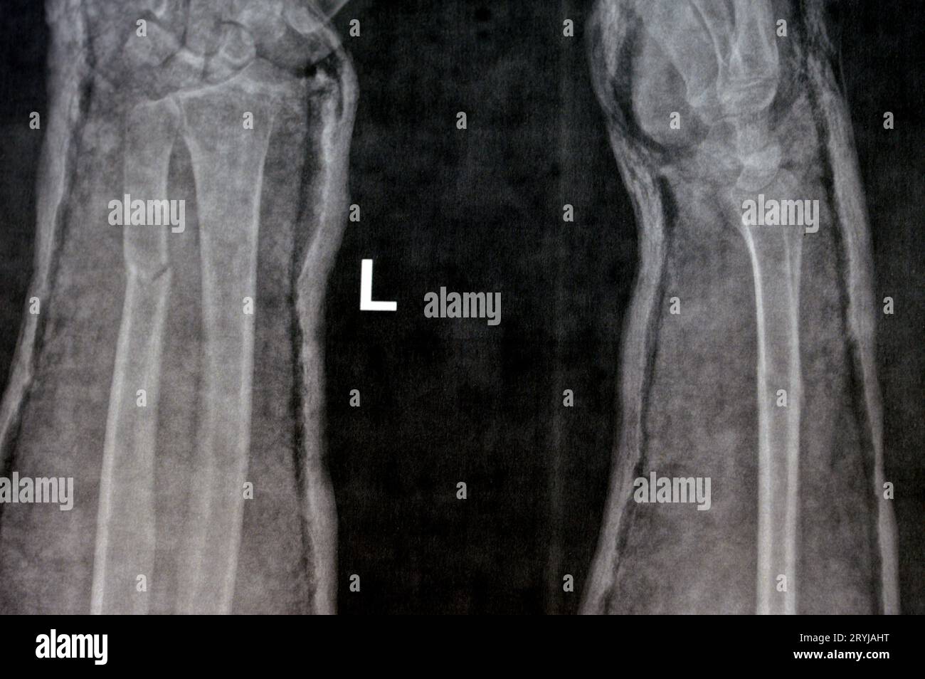 Plain X ray of right forearm (mistakenly written Left on the film ...