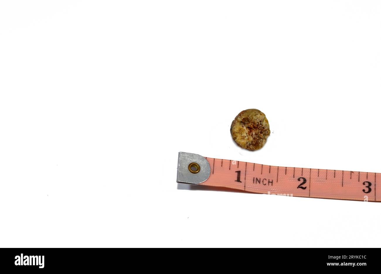 Large gallstone removed surgically after laparoscopic cholecystectomy ...