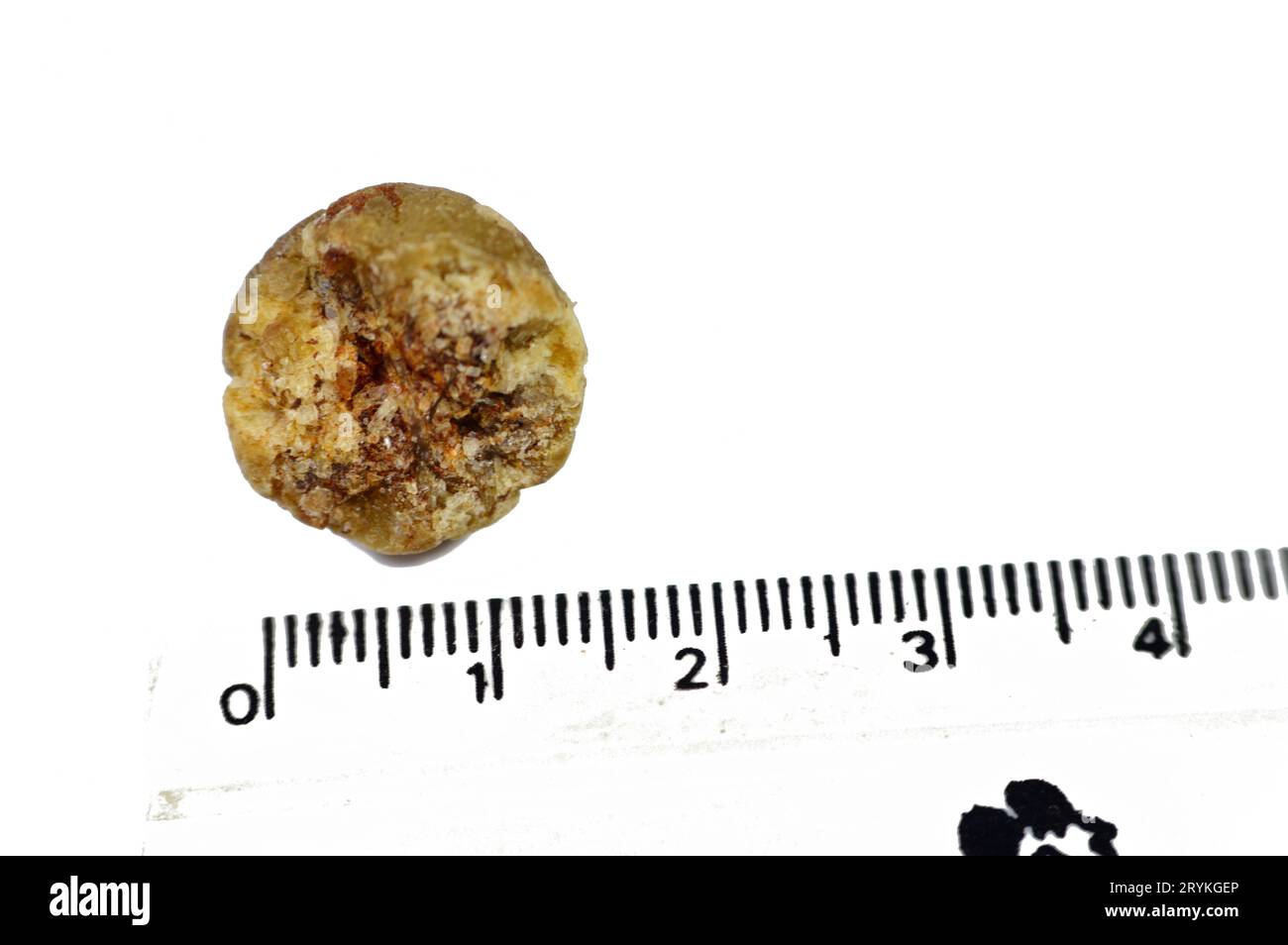 Large gallstone removed surgically after laparoscopic cholecystectomy ...