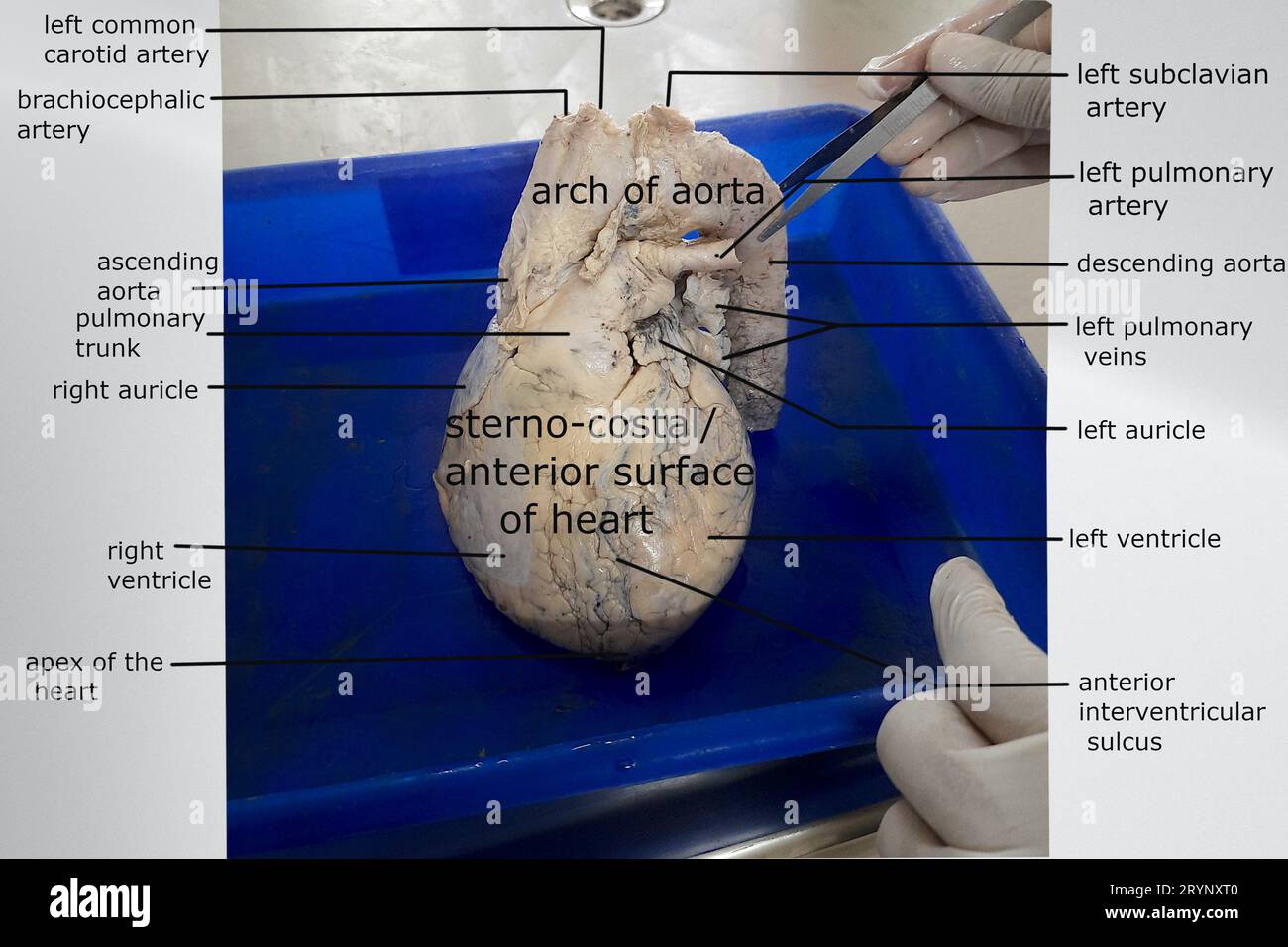 dissection image of the muscle of the thigh with showing sciatic nerve ...