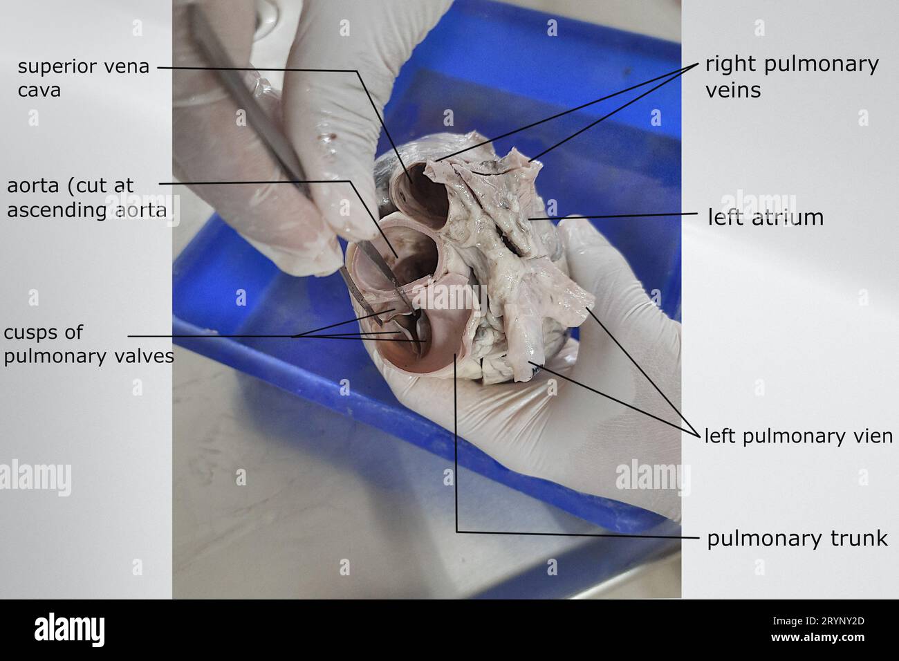 superior view of heart showing opening of aorta, superior vena cava ...