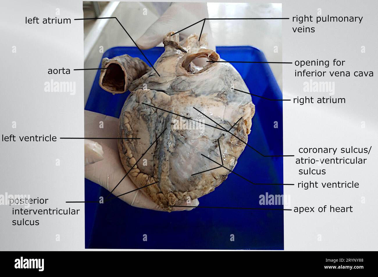 anatomical features of base and the diaphragmatic surface of heart with ...