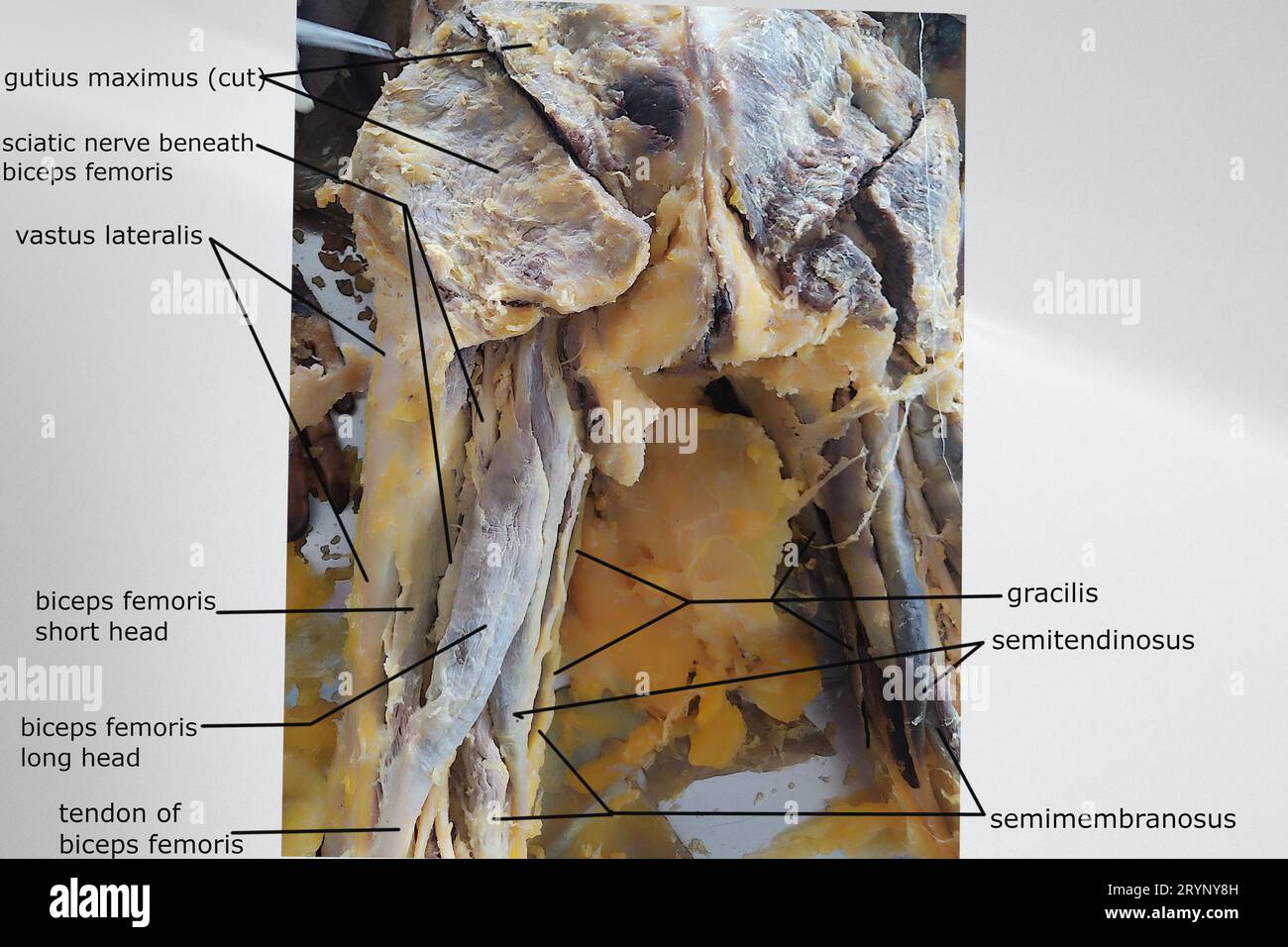 image showing muscles of gluteal region and the posterior compartment ...